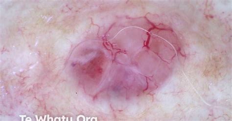 Nodular Basal Cell Carcinoma Polarised Dermoscopy View Image Nodular Basal Cell Carcinoma Polarised Dermoscopy View Image
