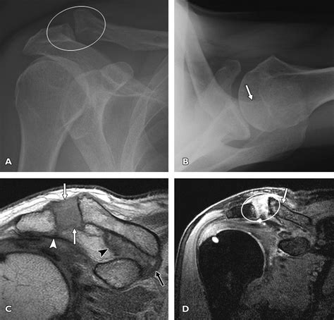 Mri Versus Radiography Of Acromioclavicular Joint Dislocation Ajr My