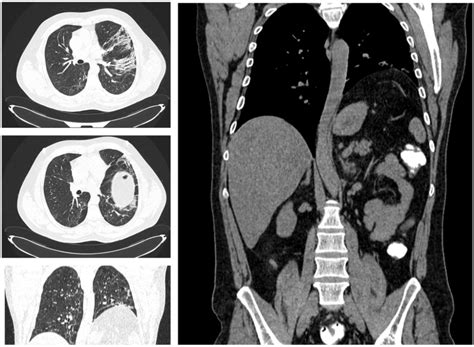 Chest Ct Scan On Three Months After Hospital Discharge Corresponding