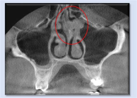 Ostiomeatal Complex Obstruction