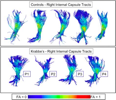 Visualization Of Dti Fiber Tracts Through The Right Hemispheric