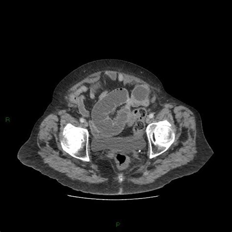 Closed Loop Obstruction Radiology Reference Article