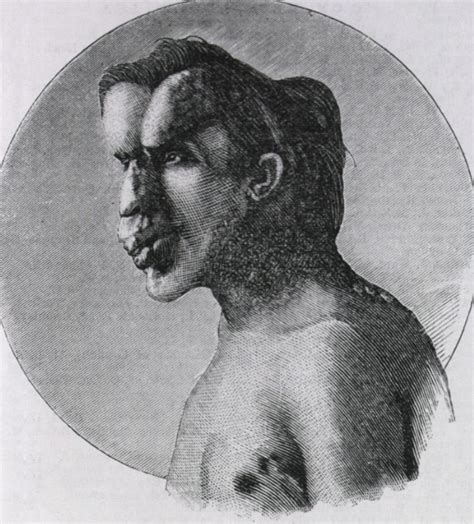 The Heartbreaking Story Of Joseph Merrick The Elephant Man Who Sought