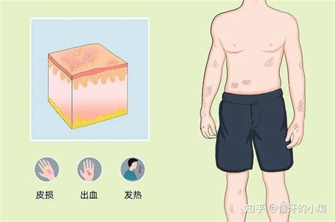 口腔与艾滋 知乎