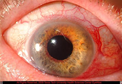 Neovascularization Of Iris