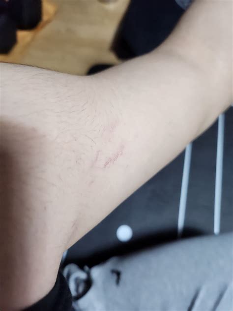 이거 실 핏줄 터진건가요 운동 건강 아싸 에펨코리아