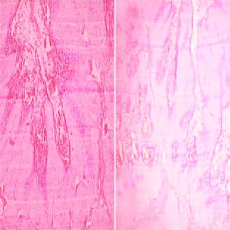 Sections Showing Hyperplastic Squamous Epithelium Along With Download Scientific Diagram