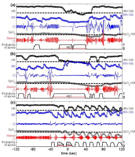 A New Algorithm For Detecting Central Apnea In Neonates Abstract Europe PMC
