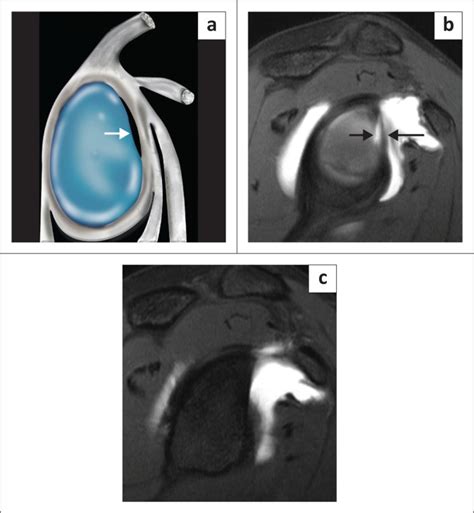 Superior Labrum Anterior To Posterior Lesions Part 1 Imaging And
