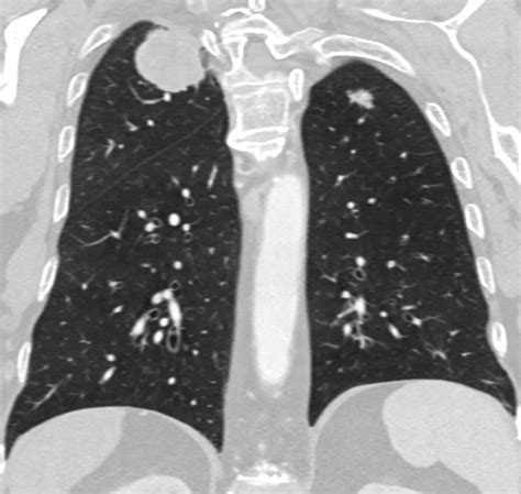 Lobulated Lung Tumor With Contralateral Lung Metastasis Download Scientific Diagram