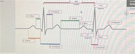 Solved Abels X P Wave X Q Wave X Q T Interval X P R Interval Chegg Com