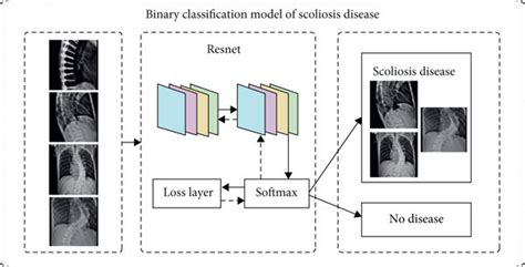 Binary Classification Model Of Scoliosis Disease Download Scientific Diagram