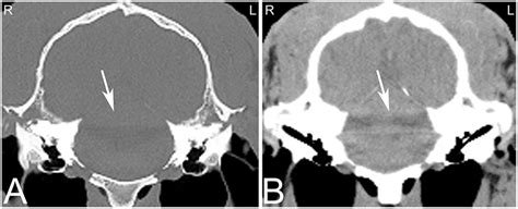Beam Hardening Artifacts Radiology The Best Picture Of Beam