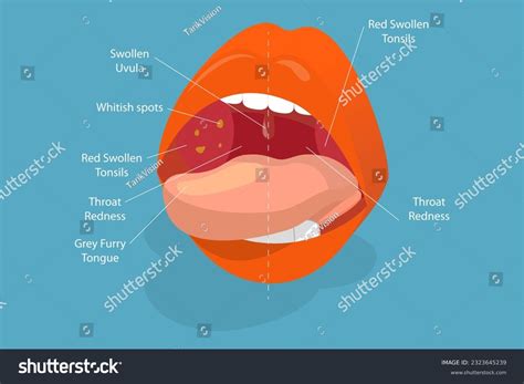 3d Streps Medicine Over 1 Royalty Free Licensable Stock Vectors