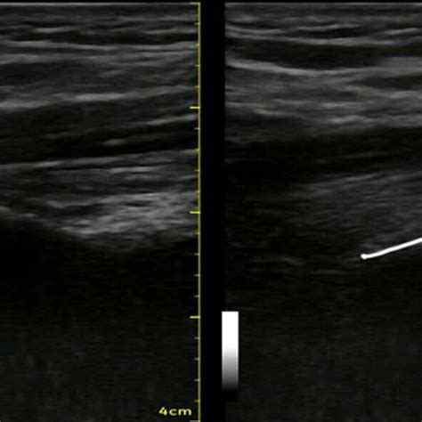 Cervical Medial Branch Block Orange Dot Medial Branch Nerve White Download Scientific
