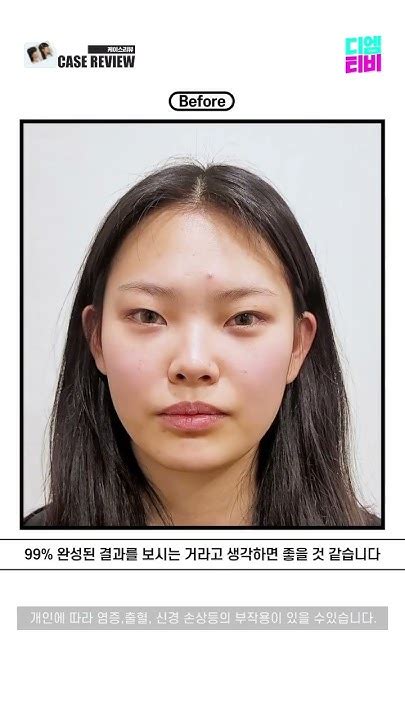 마지막에 웃는 모습 존예당💗 Shorts 눈성형 코성형 지방이식 Youtube