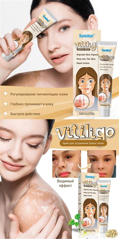 Мазь для лечения белых пятен на теле Крем для усиления пигментации при витилиголейкодерма лишай
