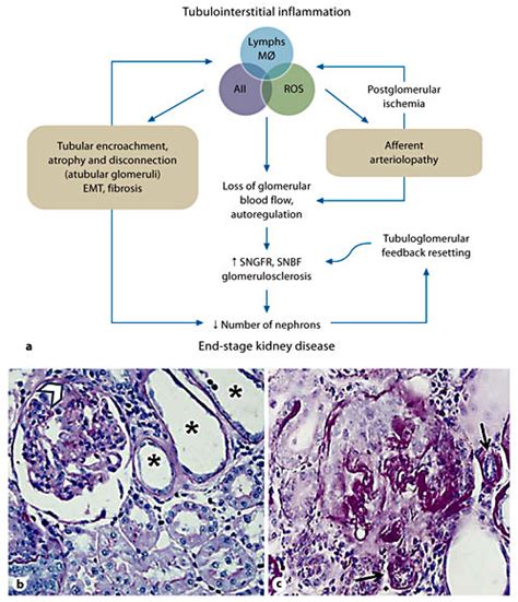 The Role Of Tubulointerstitial Inflammation In The Progression Of