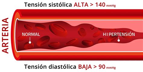 Hipertensión Arterial Gobierno Vasco Euskadieus