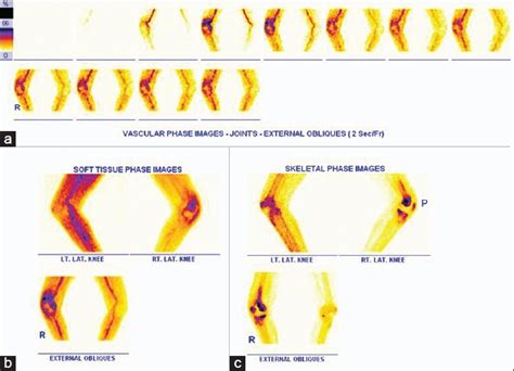 Display Of A Regional Three Phase Bone Scan Tbs That Was Performed Download Scientific