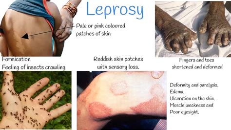 Symptoms Of Leprosy On Feet Symptoms Of Leprosy On Skin Bdne