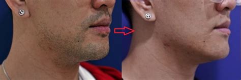 남자 얼굴 수염 레이저 영구 제모 5회 치료 후기 부작용 턱수염 구레나룻 인중 볼 목 제모 전후 사진 네이버 블로그