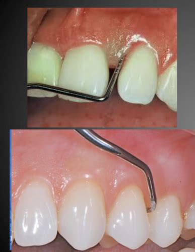 Periodontics Flashcards Quizlet