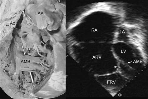Medicare Ebstein Anomaly