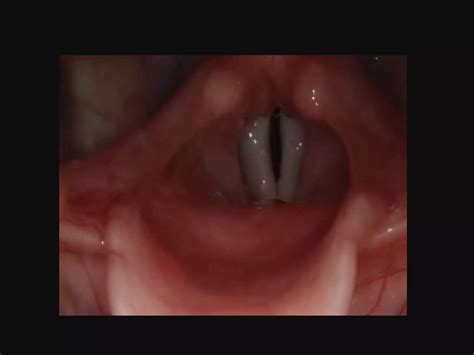 Vocal Cord Lesions And Phonomicrosurgery Pptx