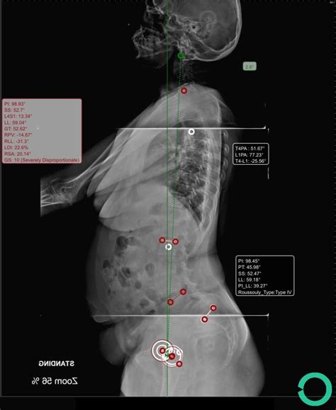 Decompression Fusion Correction Spondylolisthesis Disc Endoscopic