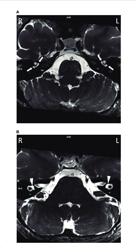 The Decreased Bright Cochlear Fluid Signal On T2 Weighted Images In Download Scientific