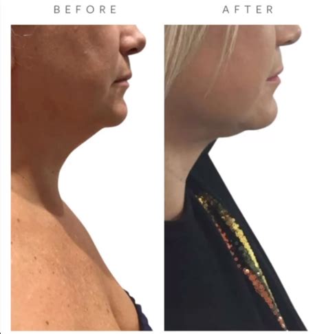 Contoura Medical Gallery See Stunning Vaser Lipo And Skin Tightening Results