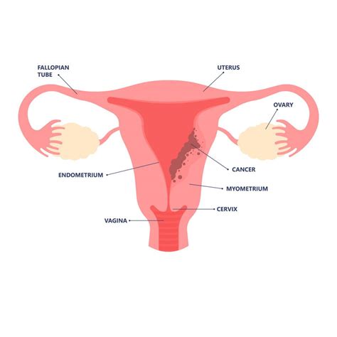 Endometrial Cancer Symptoms Causes And Treatments Vejthani