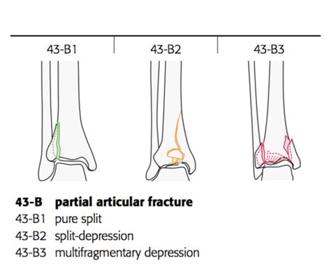 Distal Tibia Fracture Classification