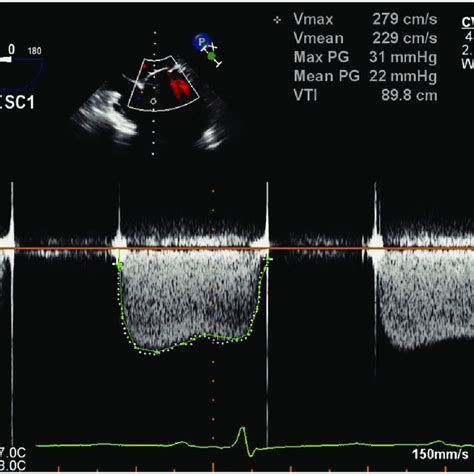 Continuous Wave Doppler Through The Mitral Valve Transthoracic Download Scientific Diagram