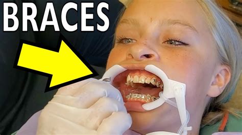 Teen Gets Braces Right Before High School Youtube