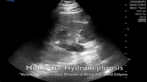 Moderate Hydronephrosis On Pocus Be Sure To Add Color Grepmed