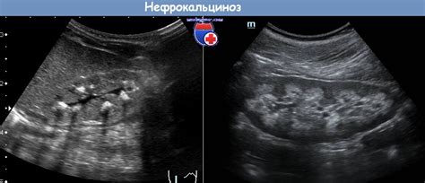 Амилоидоз почек. Медуллярный нефрокальциноз. Обструкция уретры на УЗИ.