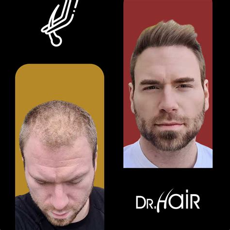 Hair Transplant Turkey Women Drhair