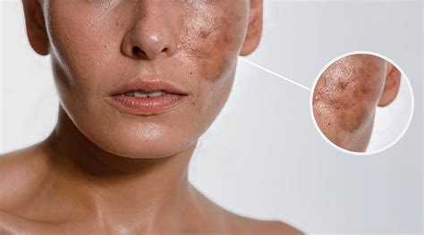Hyperpigmentation 101 Types Treatments And Causes Exclusive Beauty