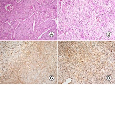 A Colonoscopy Showed Multiple Polyps On The Terminal Ileum Some Flat Download Scientific