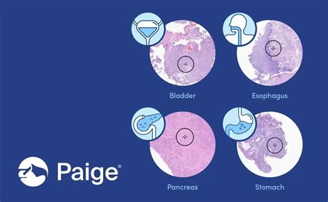 Breaking Through The Complexity Of Cancer Detection — Paigeai