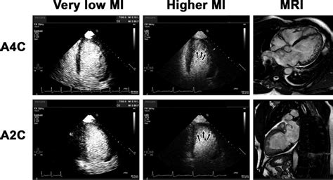 Masking And Unmasking Of Isolated Noncompaction Of The Left Ventricle