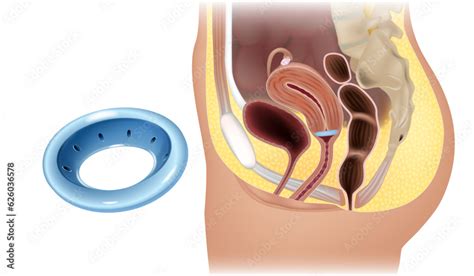 Vaginal Pessaries Support Pessaries For Pelvic Organ Prolapse