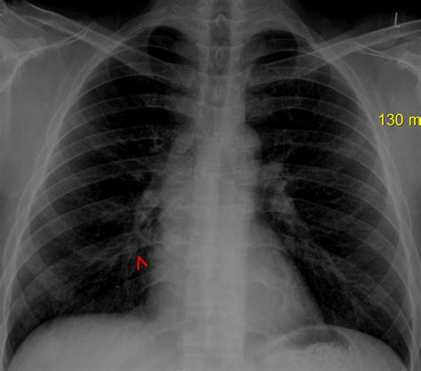 폐렴 측면 흉부 엑스레이