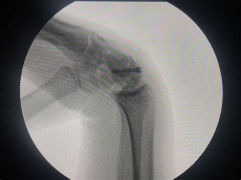 Scaphoid Proximal Pole Fracture R Radiology