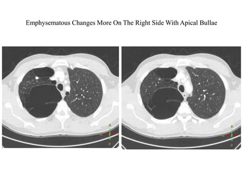 Differential Diagnosis Of Pulmonary Cyst 1 Bullous Emphysema 2 Cystic Bronchiectasis 3