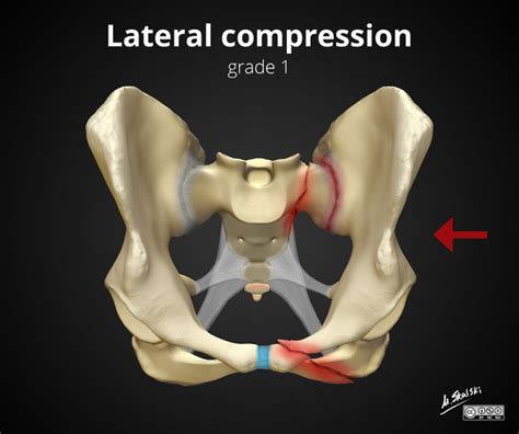 Compression Fracture Diagram