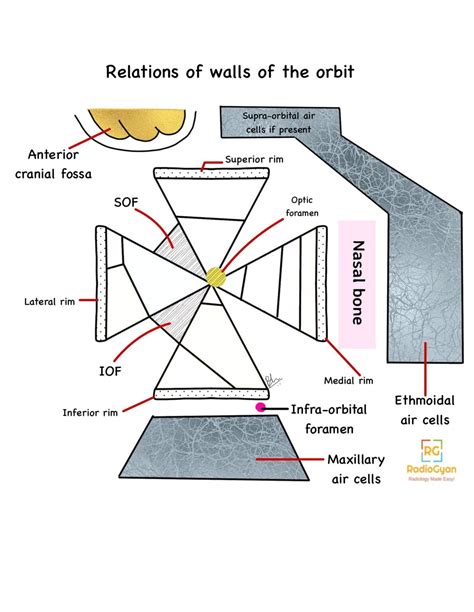 Blow Out Fracture Of The Orbit Radiology Case Radiogyan