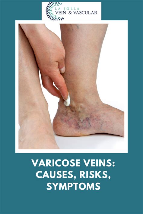 Varicose Vein And Vascular Treatment
